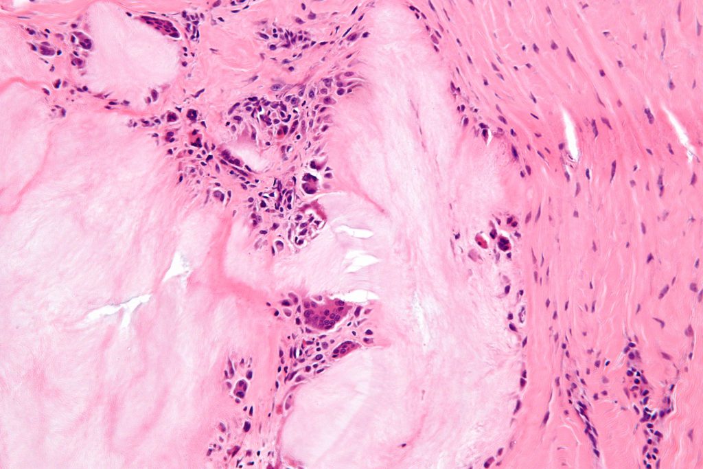 Giht i ishrana kod gihta